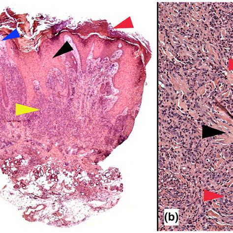 Hyperkeratotic Coalescent Verrucous Nodules On Extremities Download Scientific Diagram