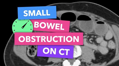 Small Bowel Obstruction On Ct Radiopaedias Emergency Radiology