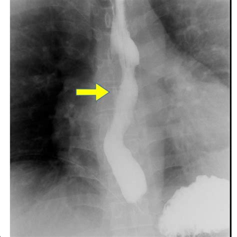 Pdf A Thoracoscopically Resected Case Of The Diverticulum In The Middle Esophagus
