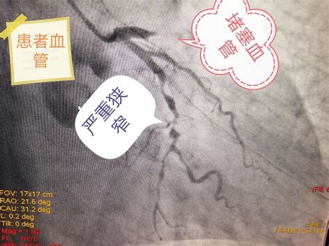 颈动脉斑块要不要吃他汀这4种情况需要他汀稳定斑块 王星副主任医师 爱问医生