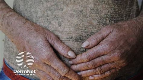 Ichthyosis Score Reliable In Skin Of Color