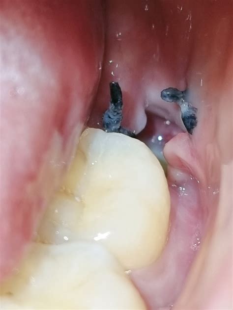사랑니 발치 후 구멍 안쪽에 흰색 뭔가요 지식in