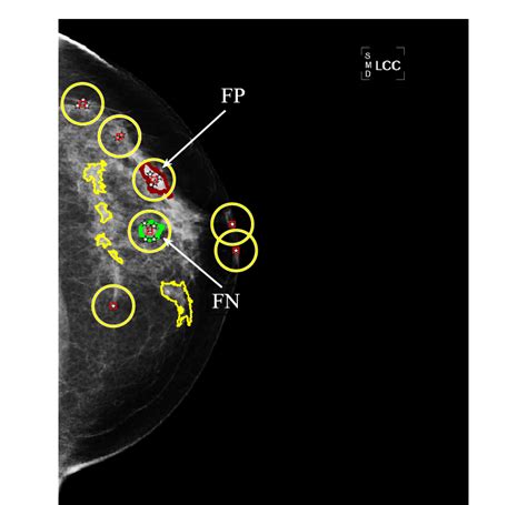 Mammogram Along With The Segmented Masses Fixations And Centers Of Download Scientific Diagram