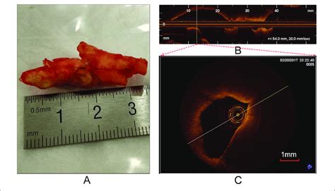 Carotid Plaque Tissue And Oct Imaging A An Intact Cea Plaque