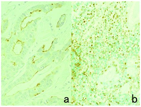Examples Of Nonspecific Immunostaining A Membranous Positivity Of Download Scientific