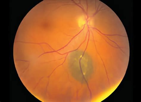 Choroidal Nevus Treatment Retinal Consultants Medical Group