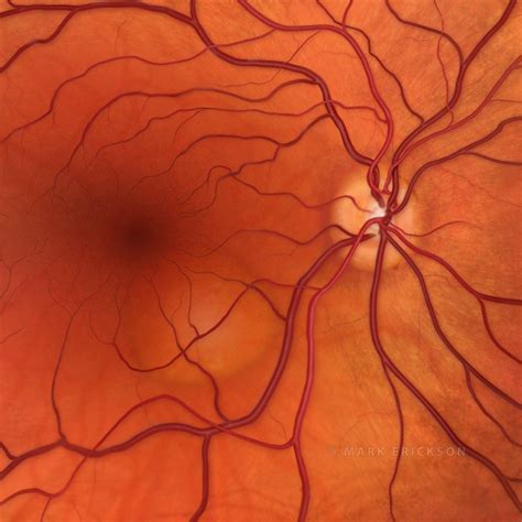 Central Serous Chorioretinopathy Csc Csr Serous Detachment Image