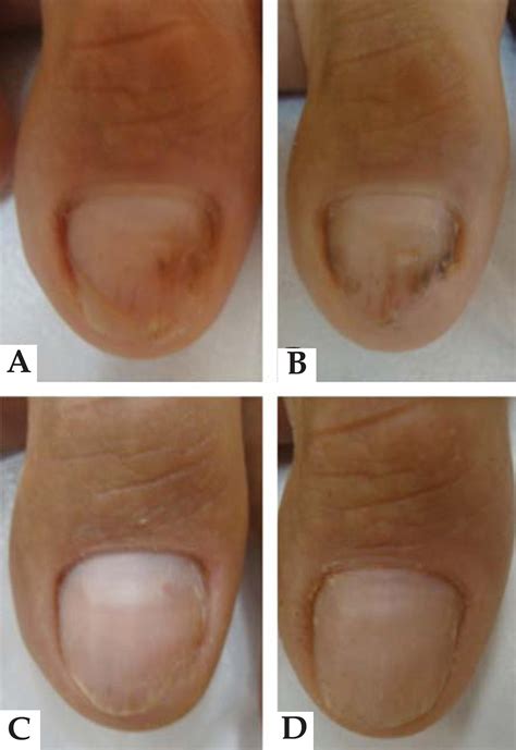 Trichophyton Rubrum Nail Treatment Ajiv