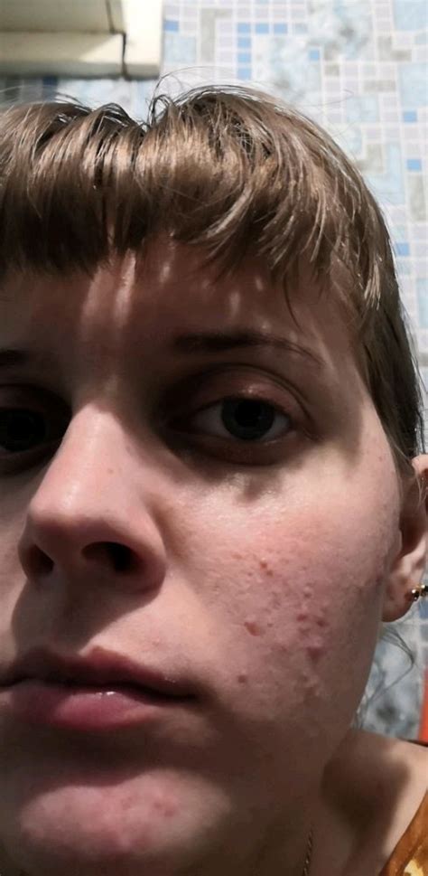 Что обозначают прыщи на лице фото