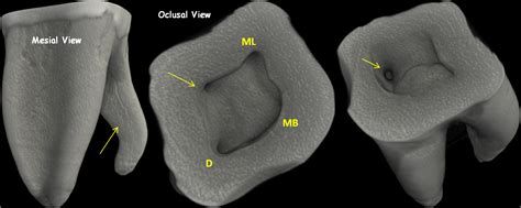 The Root Canal Anatomy Project Mandibular Second Molar Radix Entomolaris