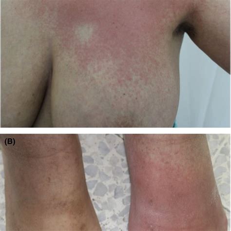 A Maculopapular Confluent Erythema Involving The Left Axilla