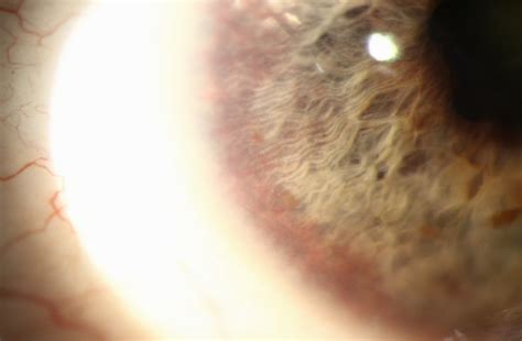 Neovascularizacao Da Iris Neovascularização Ocular Do Segmento