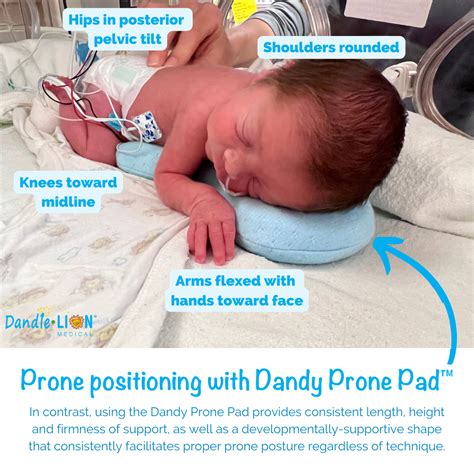 Consistency Is Key Neonatal Positioning For Neurodevelopmental Support Dandle•lion Medical