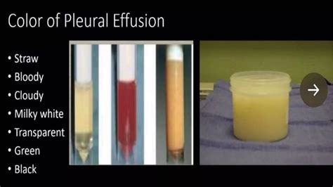 Serous Fluid Dr Shweta Autosaved Pptx Lung And Respiratory Health