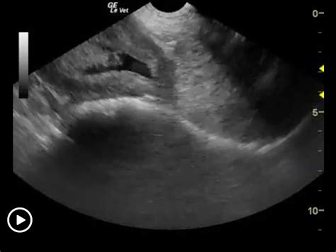 Transitional Cell Carcinoma Ultrasound