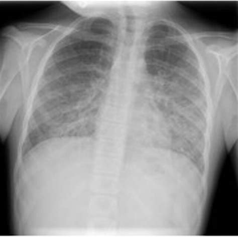 Chest X Ray Demonstrating Bilateral Pulmonary Infiltrates Caused By Download Scientific Diagram