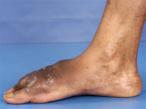 Mrsa Infectie Op De Voet