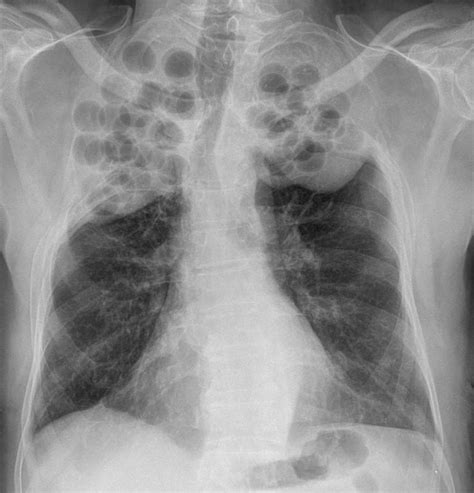 Cxr Case 045 • Litfl • Chest X Ray Self Assessment Quiz