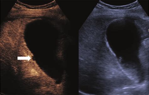 Simultaneous Grayscale And Contrast Enhanced Ultrasound Ceus Of The