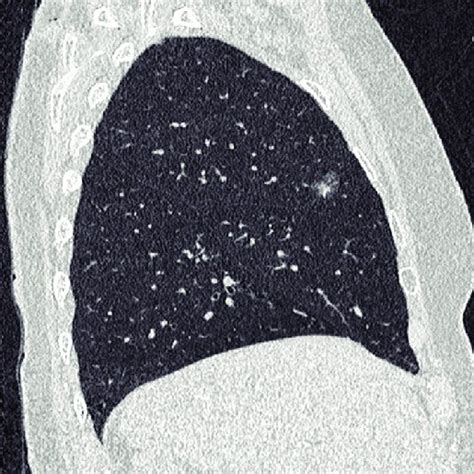 Ct1an0 Ground Glass Opacity Of The Right Upper Lobe Anterior Segment Download Scientific Diagram