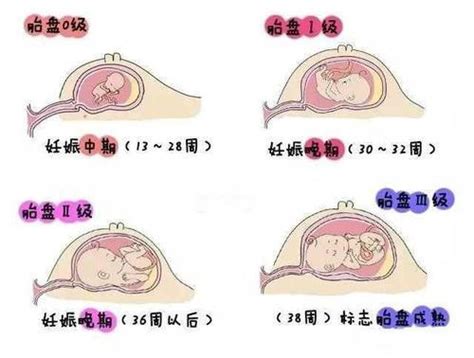 胎盘成熟度几级时才能生？ 漳州正兴医院妇产科 科室新闻 漳州正兴医院