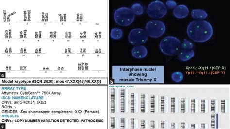 Unravelling The Impact Of An Additional Sex Chromosome In An Adult