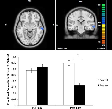 Functional Connectivity Analyses With Left Amygdala Seed Resulted Into