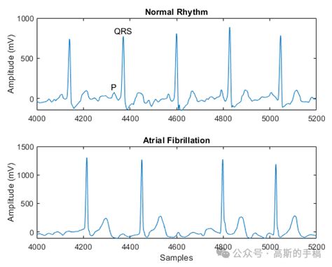 基于双向长短时记忆网络的ecg心电信号识别（包括原始时域信号与时频域特征提取，matlab R2021b）