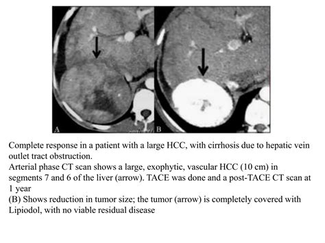 Tace Transarterial Chemoembolisation Pptx