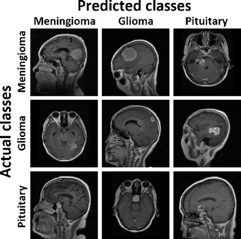 Figure 2 From Brain Tumor Segmentation From Multi Spectral Mri Records Using A U Net Cascade
