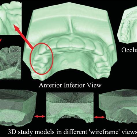 A The Occlusogram Illustrates The Amount Of Inter Occlusal Contacts