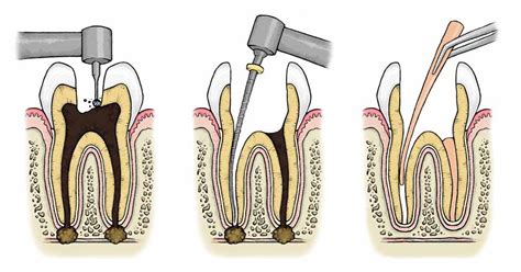 Delhidentist Root Canal Dangers For Long Term Health