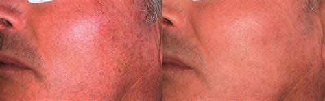 Treatment Of Telangiectatic Rosacea Prime Journal