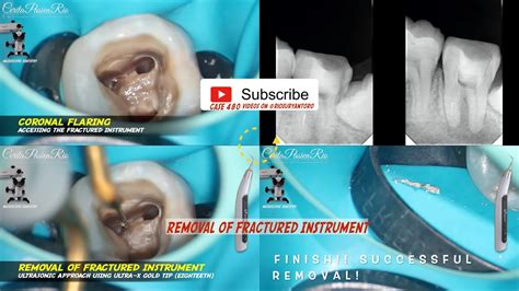 Root Canal File Removal Procedure At Jose Orr Blog