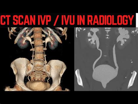 Hydronephrosis Ivp