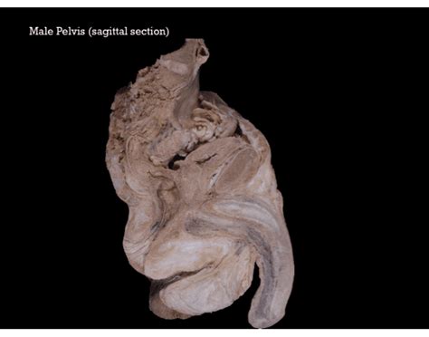 Male Pelvis Sagittal Section Quiz