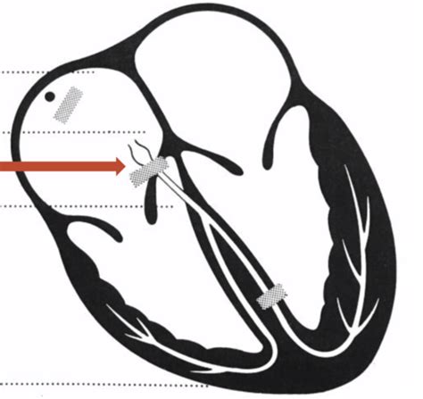 Ekg 8 Conduction Defects Flashcards Quizlet