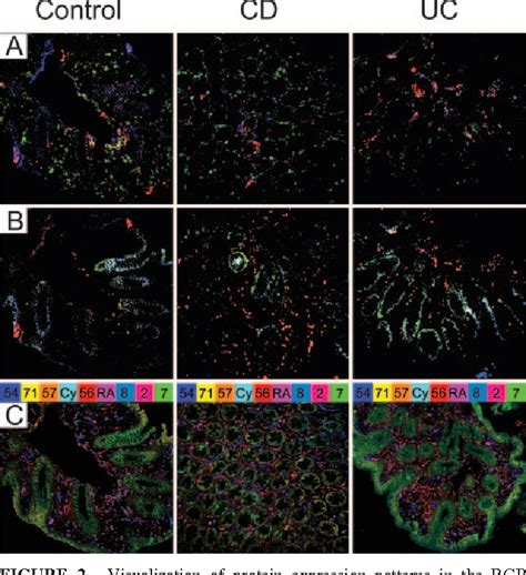 Figure 2 From Ulcerative Colitis Response Profiles In Crohns Disease