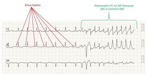 Polymorphic Vt Ecg Guru Instructor Resources
