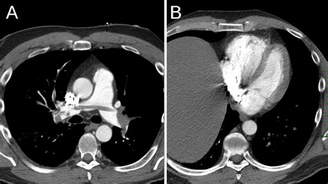 Saddle Pulmonary Embolism With Rv Strain