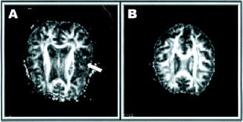 Figure Fractional Anisotropy Maps Created In A A Patient That Has