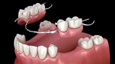 How To Care For Your Partial Dentures Dentist New Orleans