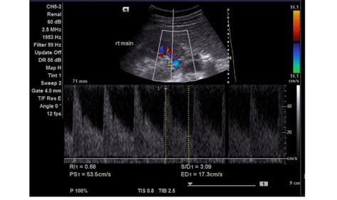 Calculation Of Renal Resistive Index Rri From Spectral Doppler Download Scientific Diagram