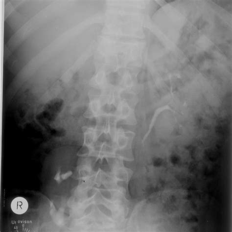 Flexible Cystoscopy Shows A Guide Wire Which Has Been Introduced Download Scientific Diagram