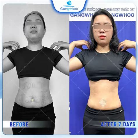 Complete Waist Liposuction Become A Model Now Gangwhoo Cosmetic