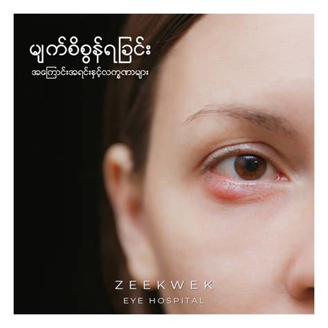 မျက်စိစွန်ရခြင်းအကြောင်းအရင်းနှင့်လက္ခဏာများ Zeekwek