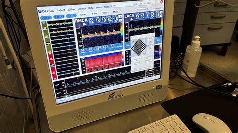 Stroke Prevention And Emboli Detection Dhs Hungary