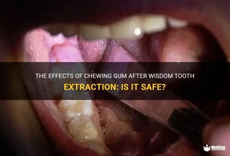The Effects Of Chewing Gum After Wisdom Tooth Extraction Is It Safe