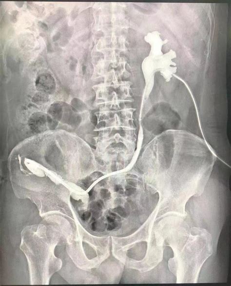 膀胱癌患者术后吻合口狭窄专家团队植入温控支架为他除顽疾 极目新闻