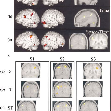 Areas Commonly Activated By Spatial And Temporal Orienting Of Download Scientific Diagram